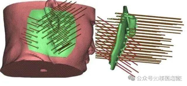 聊聊3d打印技术和放射性粒子植入：癌症治疗的实用“组合拳” 知乎 9737