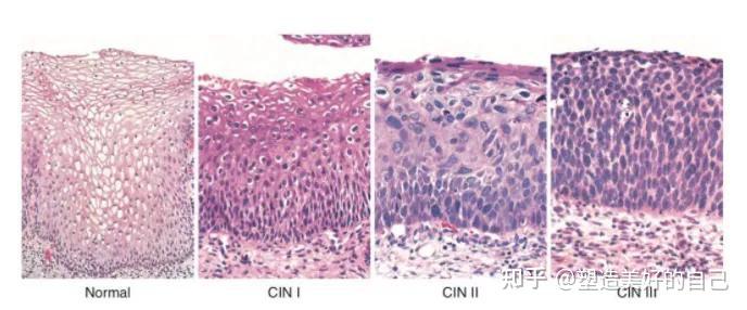 妇科LEEP手术治疗CIN，利or弊？ - 知乎