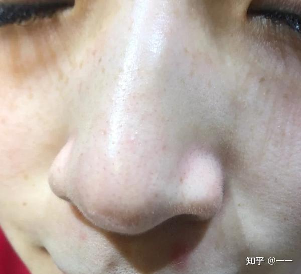 俏诺薇精华刷酸效果咋样？ 知乎