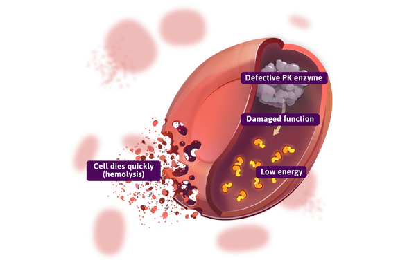 3期ACTIVATE研究显示PYRUKYND(mitapivat)对丙酮酸激酶缺乏症的益处 - 知乎