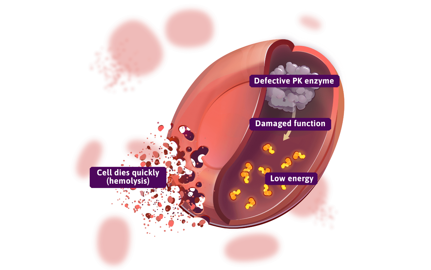 3期ACTIVATE研究显示PYRUKYND(mitapivat)对丙酮酸激酶缺乏症的益处 - 知乎