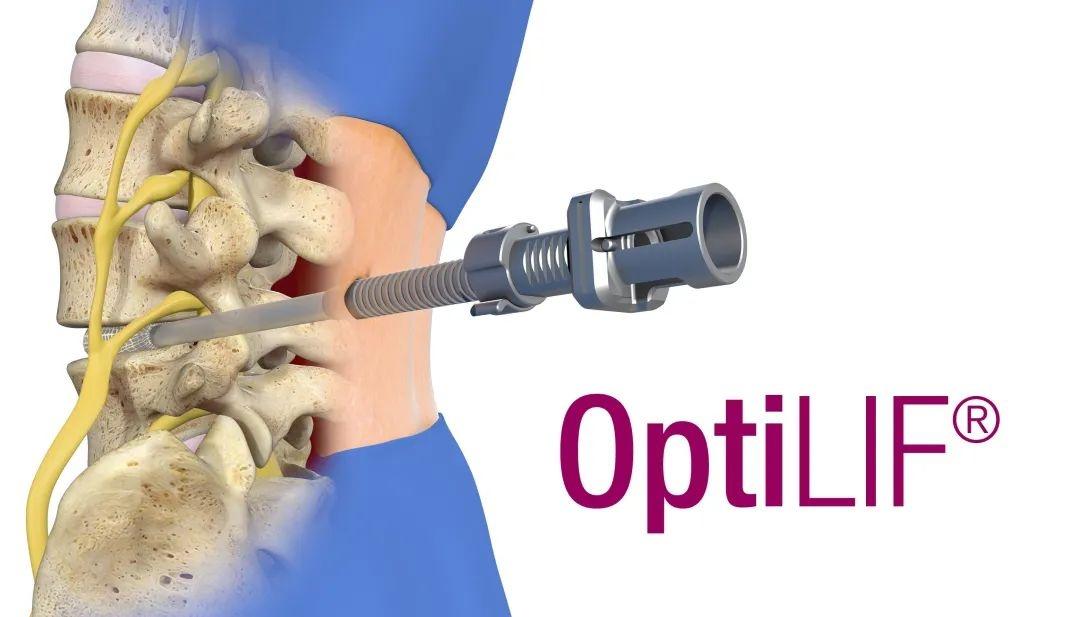 全球唯一！经内镜脊柱融合系统 - 知乎