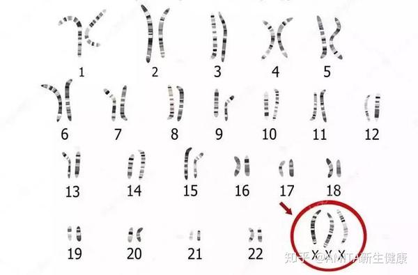 “XXY” or “XYY”：带你走进真实的“第三性别”群体 - 知乎