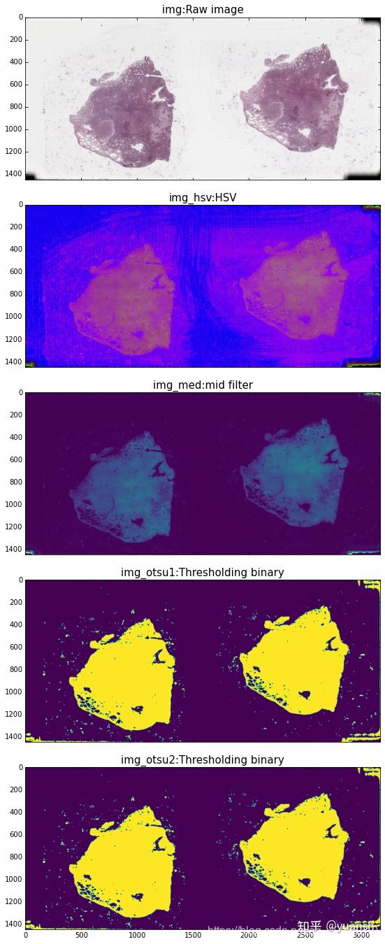 CLAM: A Deep-Learning-based Pipeline for Data Efficient and Weakly Supervised Whole-Slide-level ...