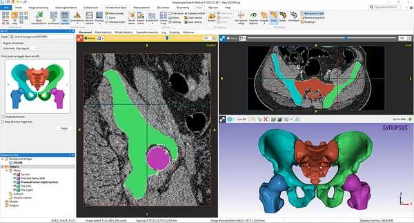 【Simpleware】髋关节翻修手术中髋臼大面积缺损的统计形状建模 - 知乎