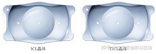 近视手术攻略-ICL晶体植入术篇 - 知乎