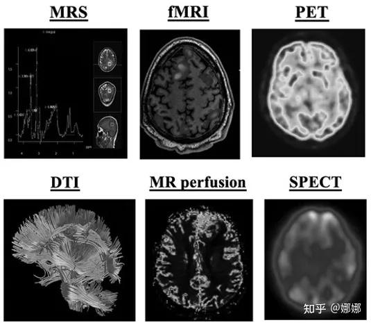 PET、MRS、DTI、fMRI…检查分不清？5大胶质瘤影像技术如何“各显神通” - 知乎
