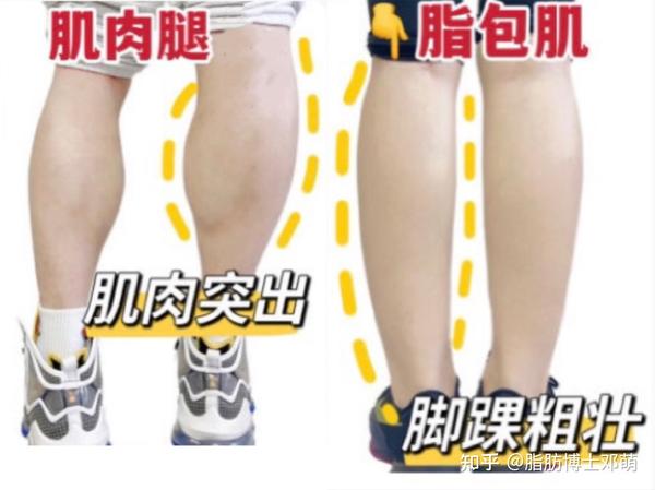 瘦腿针和小腿吸脂哪个效果更好? 知乎