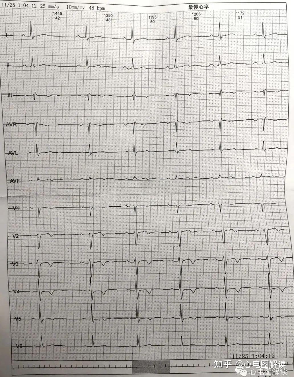 LAD 近中段发出D1处狭窄约95%--Wellens综合征 - 知乎