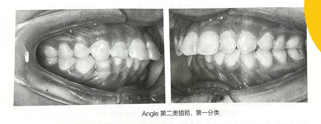 病例诊断｜错𬌗畸形的分类、检查与诊断 - 知乎
