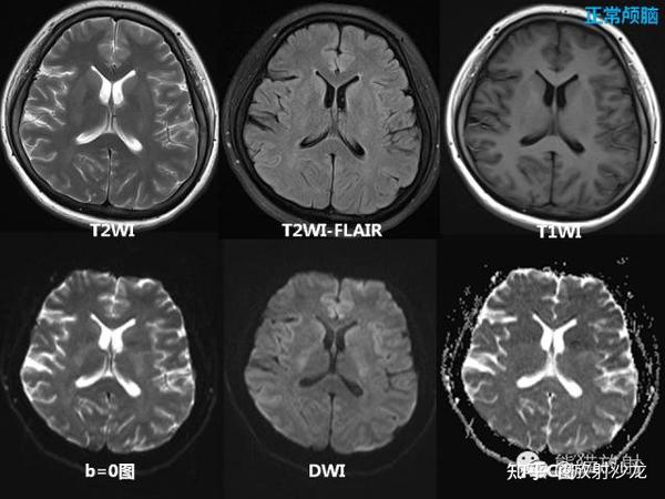 如何简单理解、认识MRI图像 - 知乎