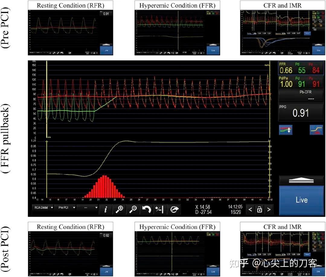 RFR与CTFFR、FFR明显不一致病例 - 知乎