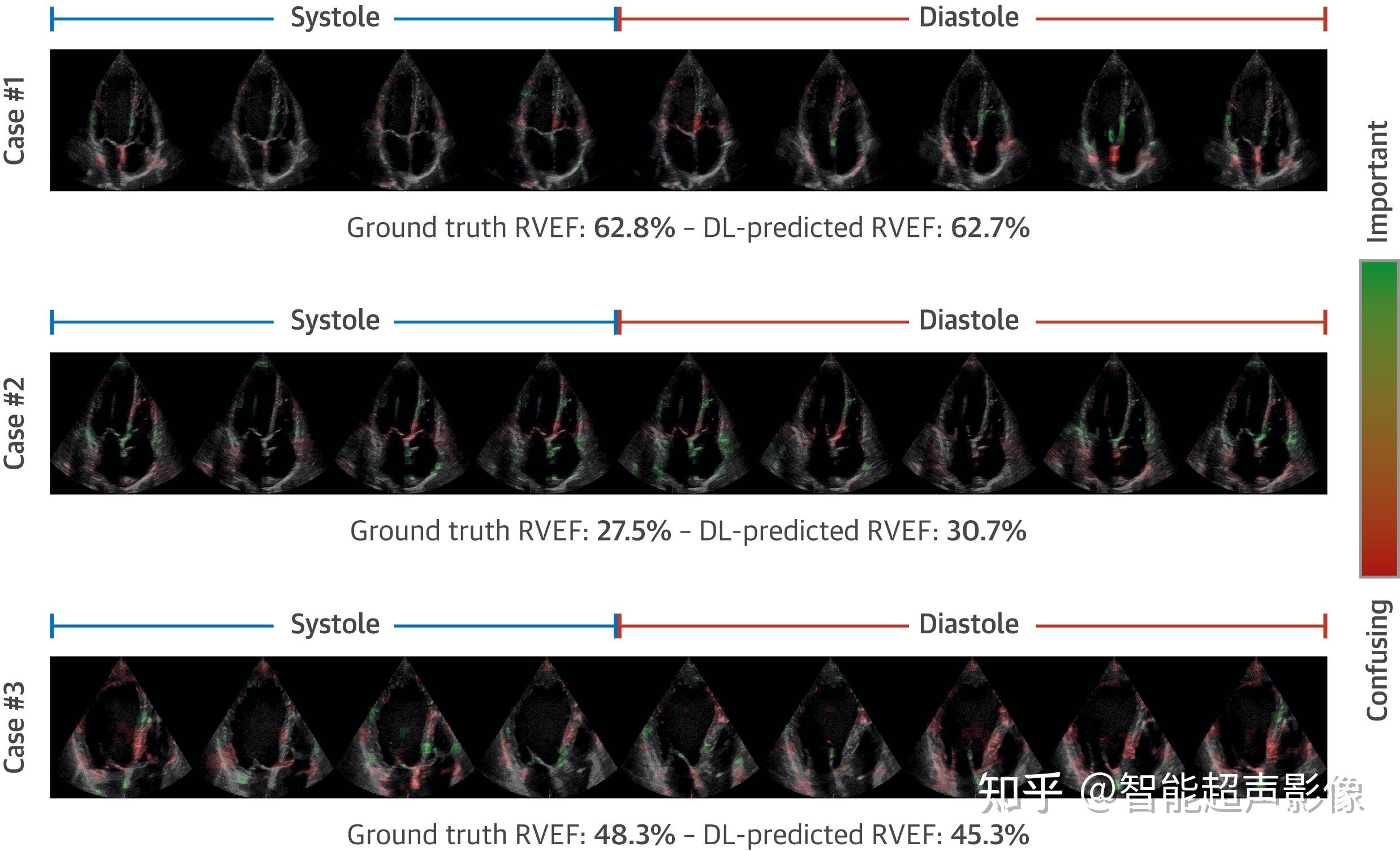 二维超声心动图无法评估右心室射血分数RVEF？ - 知乎