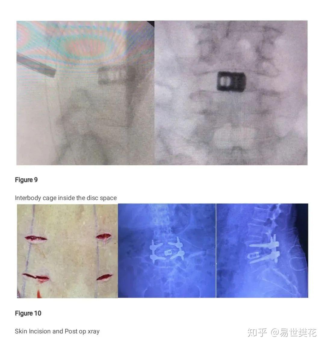 UBE单侧双通道脊柱内镜下腰椎椎体间融合术，技术要点及与传统MIS TLIF的手术比较【文献速递】 - 知乎
