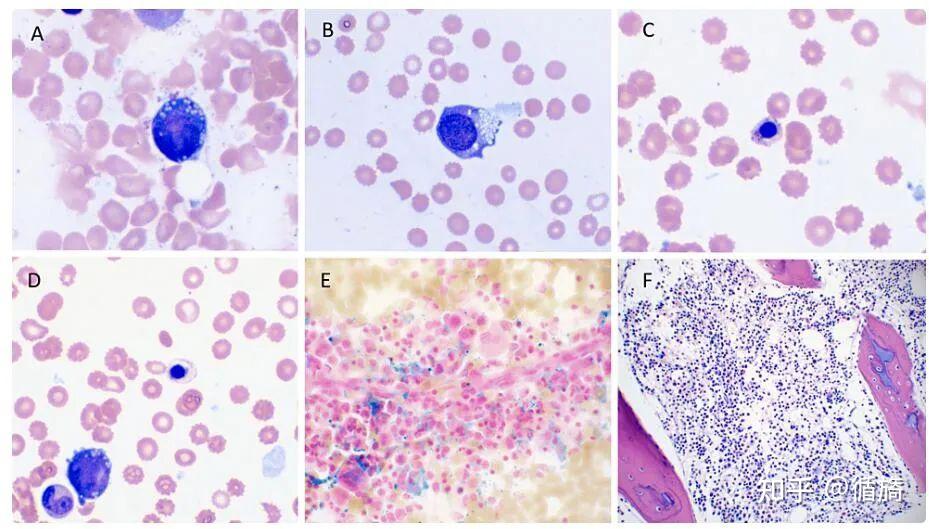 Pearson Syndrome皮尔逊综合征（PS）引起贫血、胰腺外分泌缺陷、视力异常的线粒体疾病 - 知乎