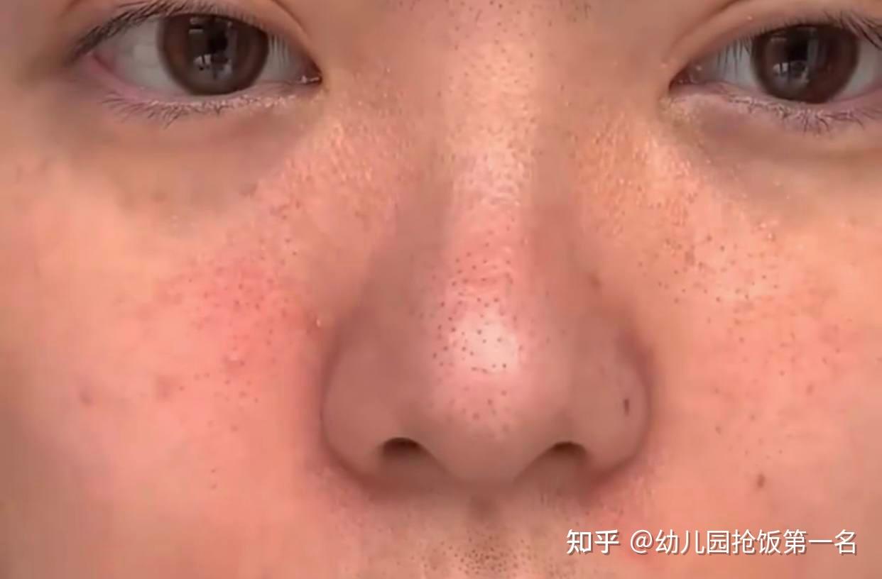 为什么黑头总是反反复复?用了刷酸、泥膜都没用!学生党到底要怎么做才能彻底去黑头?? 知乎