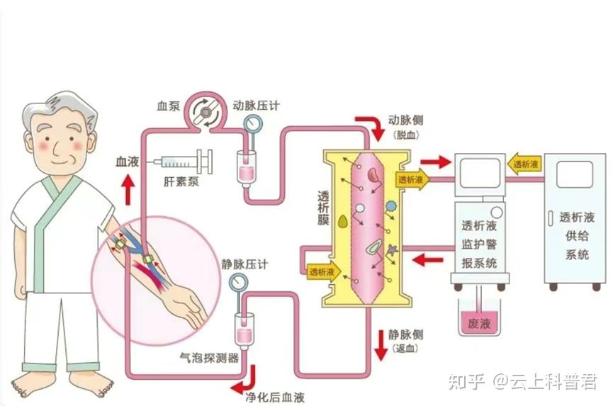 双重血浆置换（DFPP）血液净化疗法你了解多少？ - 知乎