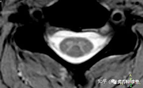 PSIR序列原理及临床应用 - 知乎