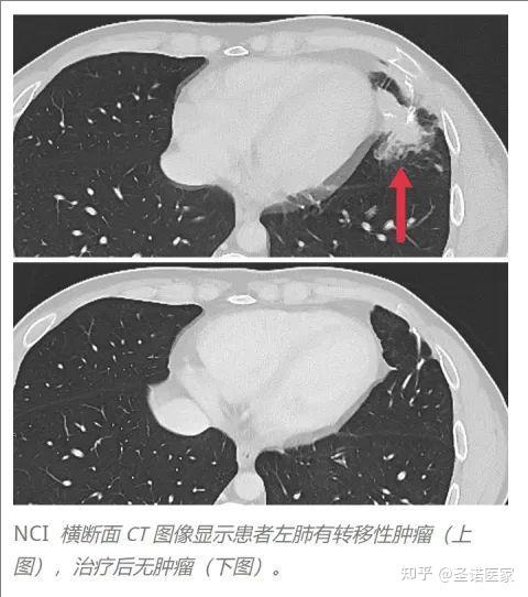 2025年欧洲肝病年会SCG101数据亮眼,TCRT细胞疗法让肝癌、肺癌、肠癌等迎破晓时刻 - 知乎
