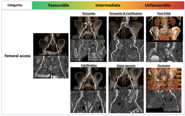 超全总结！TAVI vs. SAVR怎么选？EHJ综述聚焦“灰区”患者、终身管理······ - 知乎