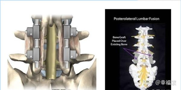 UBE 这些差别你知道吗？PLF PLIF TLIF DLIF XLIF 手术技术对比【医术苑】科普 - 知乎