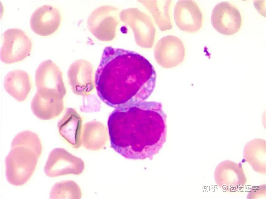 急性单核细胞白血病分型，你真的清楚吗？ - 知乎