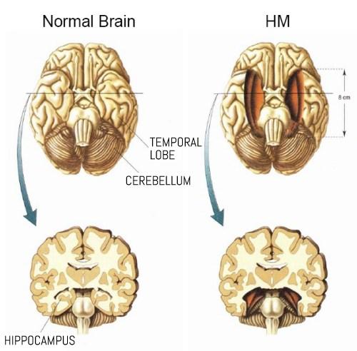 脑科学史话丨“记不住”的亨利·莫莱森，“被记住”的H.M.病人 - 知乎