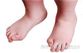 Garetosmab 可减少 FOP 成人患者的新骨病变 - 知乎