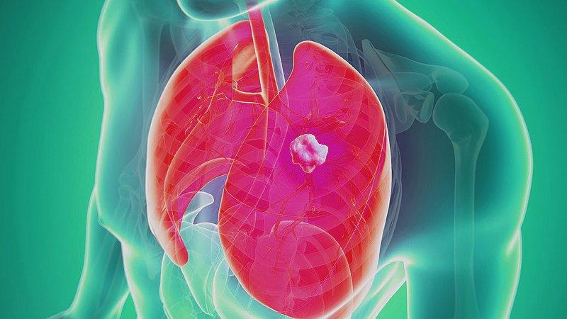 靶向METex14 跳跃突变！非小细胞肺癌新药TEPMETKO(特泊替尼) - 知乎