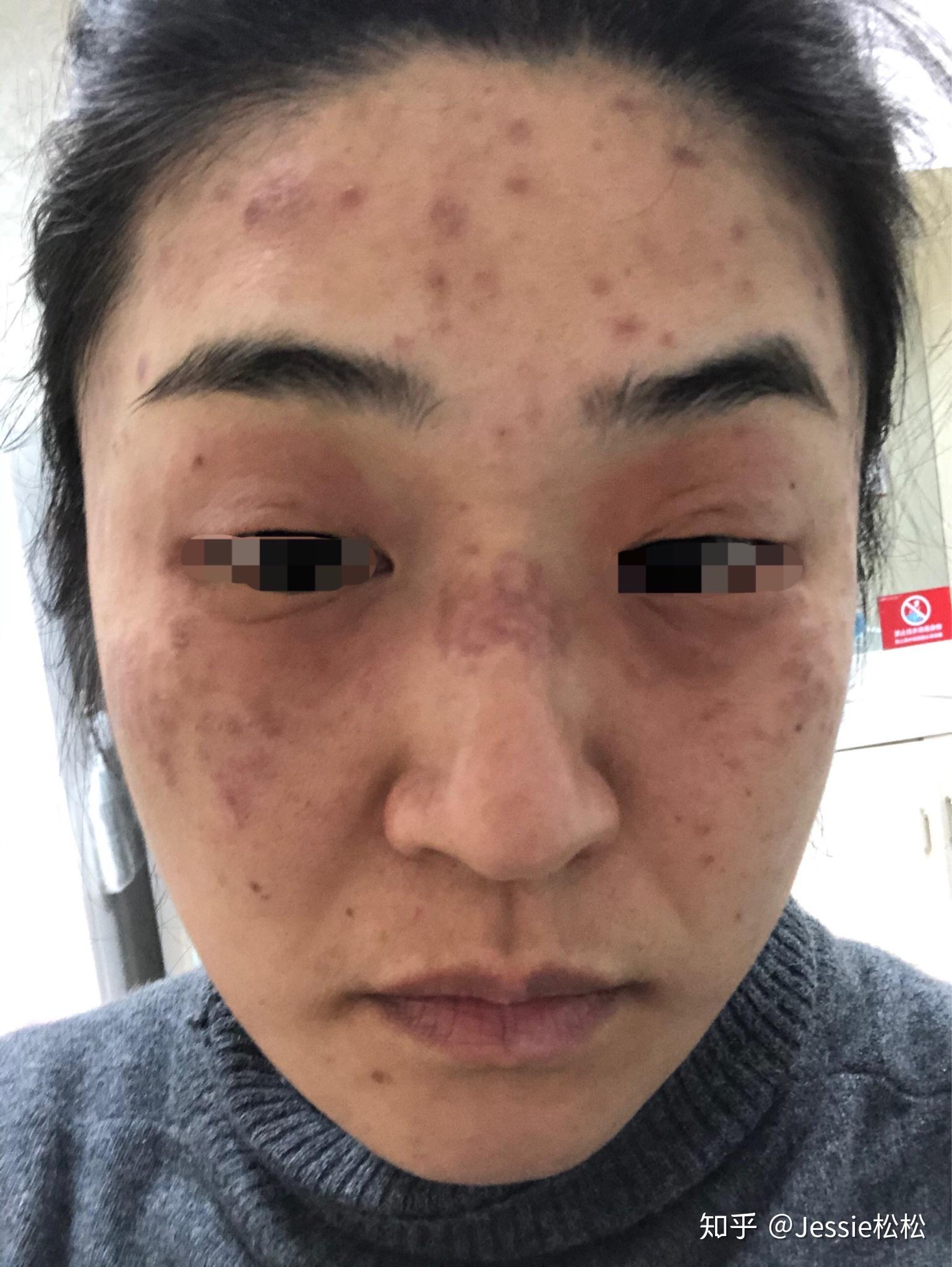 赛诺秀皮秒祛斑记录—持续更新20210828 知乎