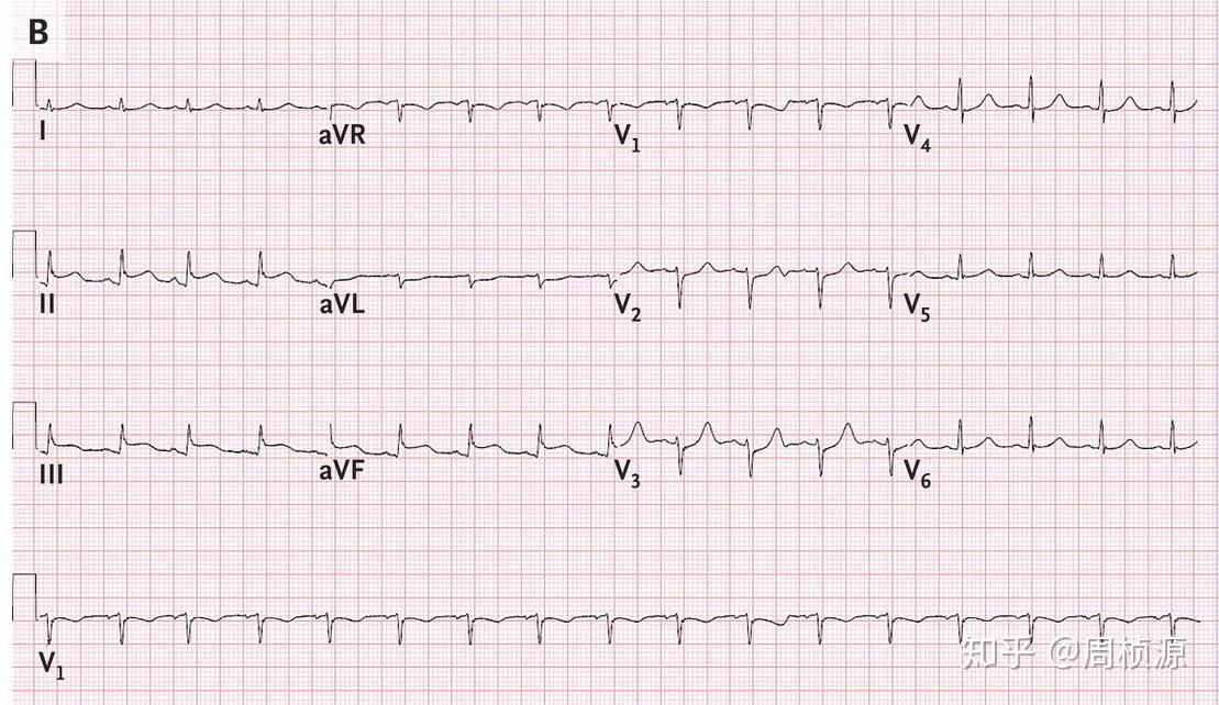 nejm 2018 case 33 - 知乎