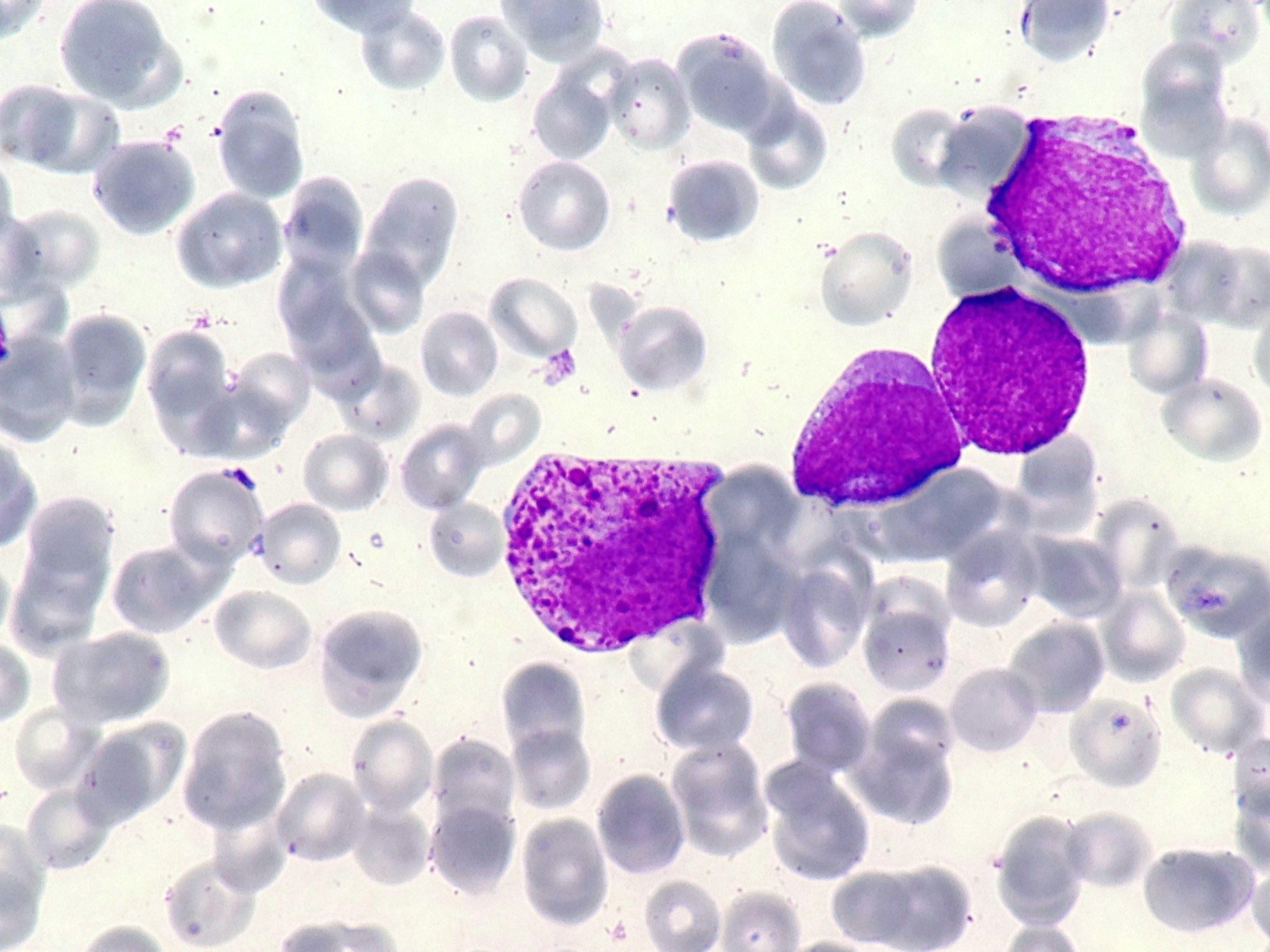 EC批准Minjuvi(tafasitamab)联合来那度胺治疗复发性或难治性弥漫性大B细胞淋巴瘤（DLBCL） - 知乎