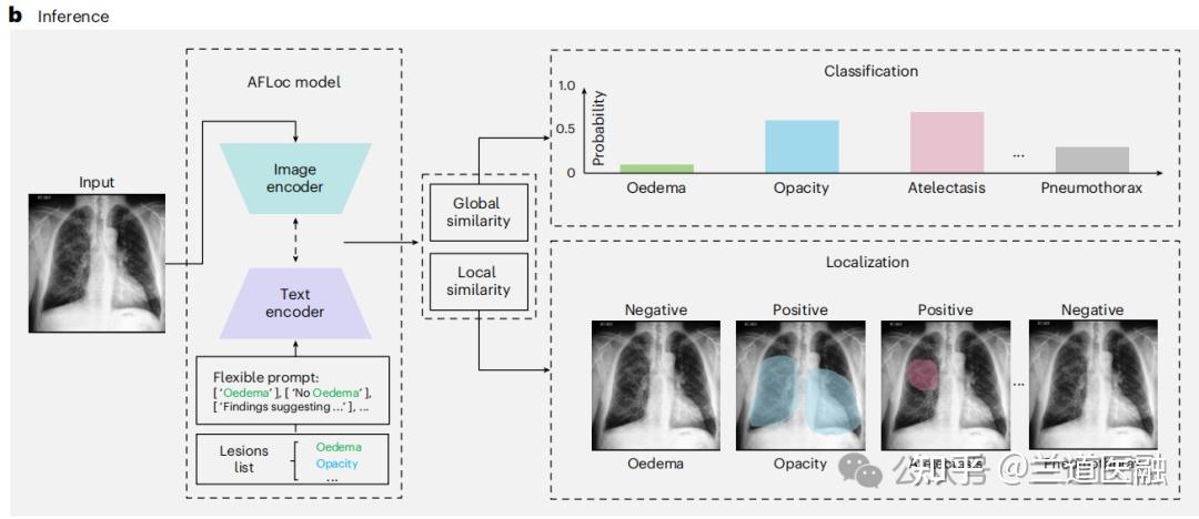 Nature子刊 | 无需标注，AI模型AFLoc自动完成病灶定位与精准诊断 - 知乎