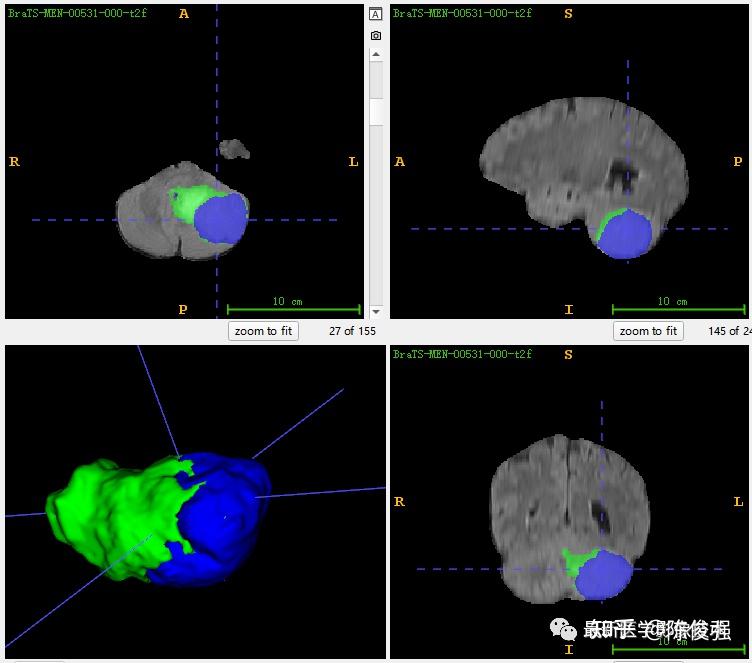 BraTS2023-MEN——BraTS2023颅内脑膜瘤分割挑战赛 - 知乎