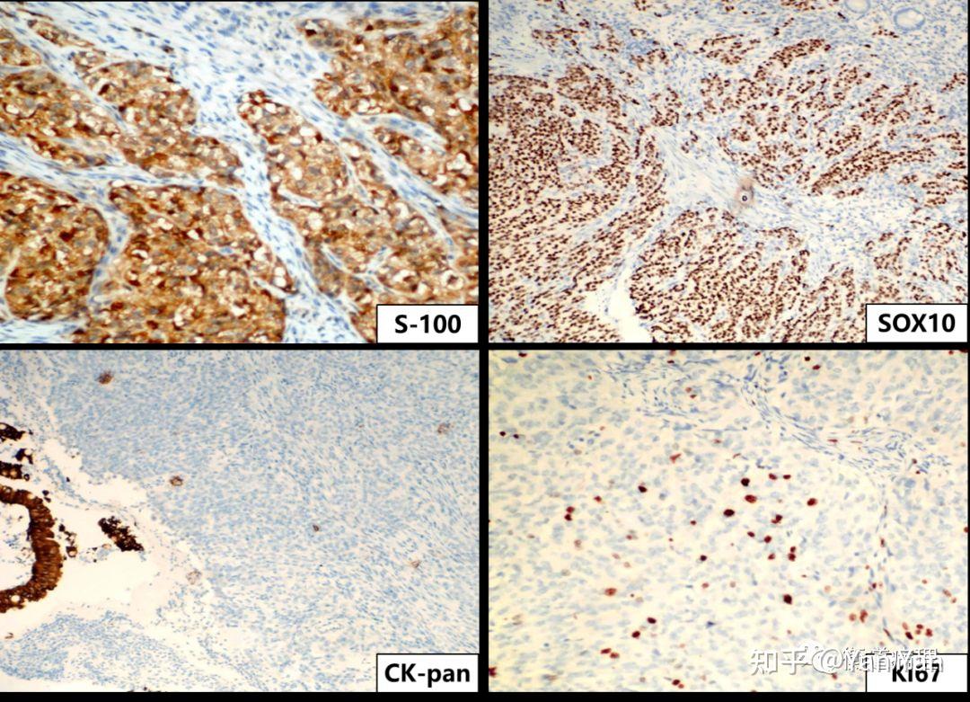 黑色素瘤临床鉴别诊断 - 知乎