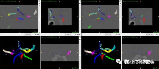 Top_Cow 2023——用于CTA和MRA的Willis环的拓扑解剖结构分割 - 知乎