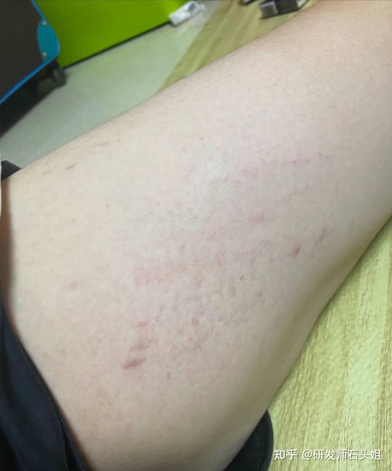肥胖纹到底能不能去掉？肥胖纹瘦了之后会慢慢消退？关于肥胖纹！我有话要说