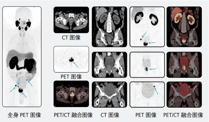 PET/CT，肿瘤诊断利器！ - 知乎
