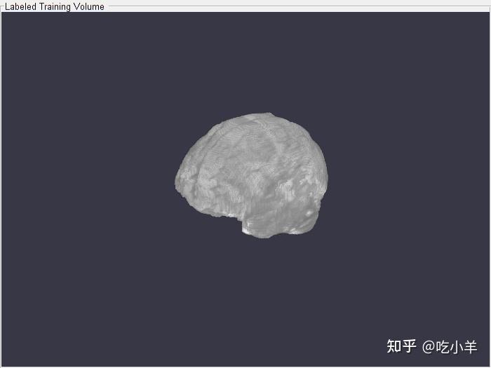 MATLAB图像处理：142：使用深度学习进行 3-D 脑肿瘤分割
