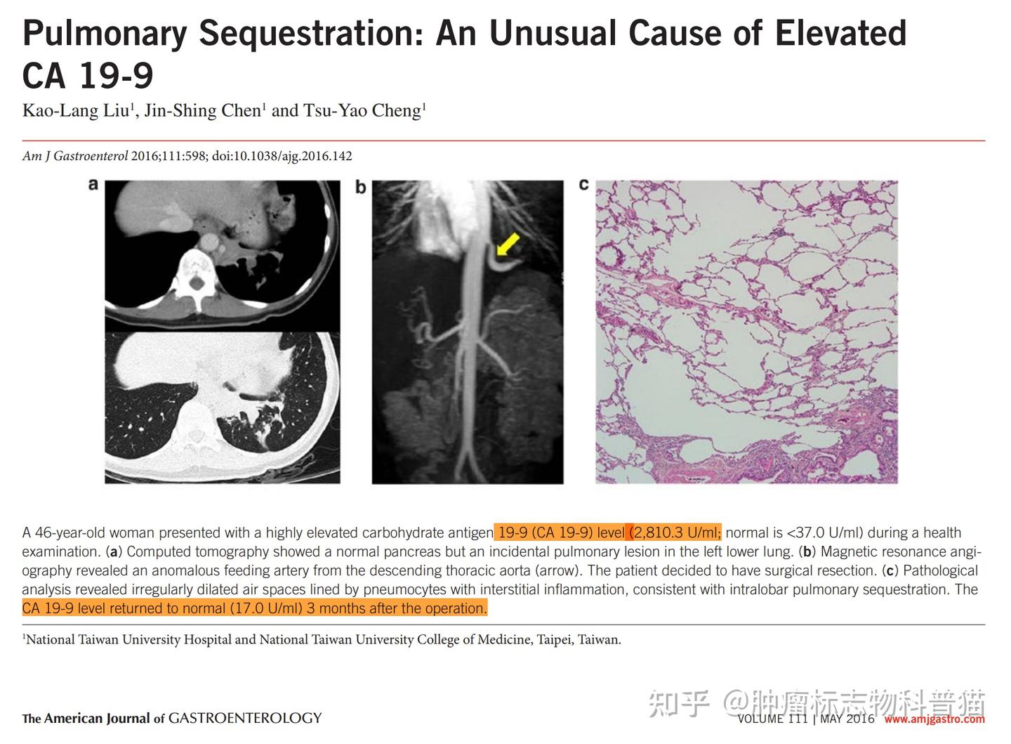 肿瘤标志物科普系列--CA199偏高原因分析（专业长文） - 知乎
