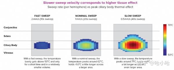 带你了解MicroPulse®跨巩膜激光治疗青光眼：国际德尔福小组的指南 - 知乎