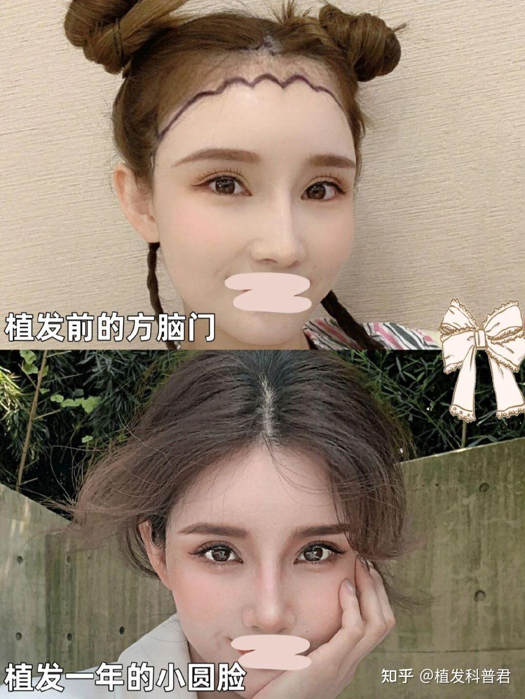 北京做的好的植发医生和医院有哪些？ 知乎