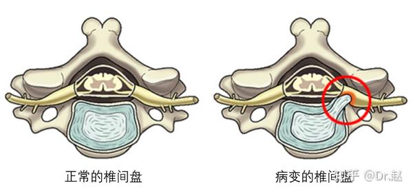 颈前路椎间盘切除融合术(ACDF) - 知乎