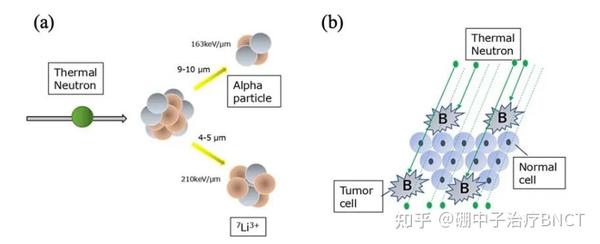 BNCT治疗复发性GBM的个案报道 - 知乎