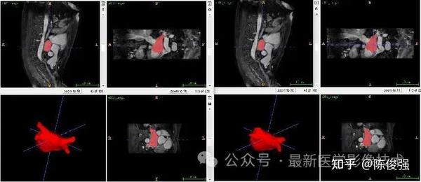 Left Atrial Segmentation Challenge 2013——MRI图像中的左心房分割 - 知乎