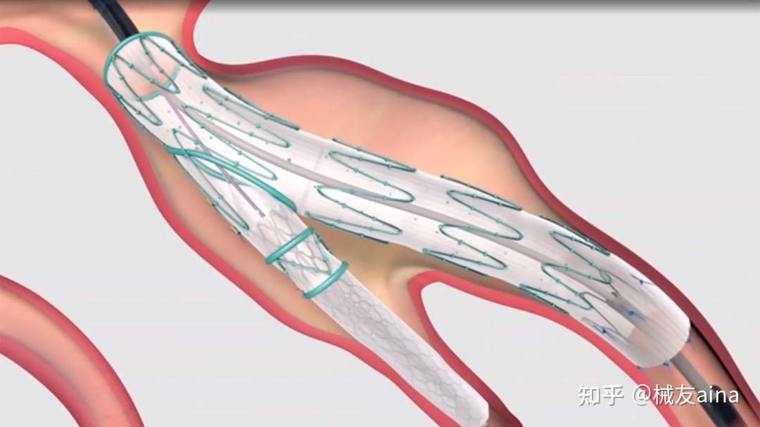 美国上市！库克ZBIS支架：髂动脉瘤患者治疗大突破，中国何时用上？ZBIS支架既“堵瘤”又“保血流”，髂动脉瘤治疗新突破！ - 知乎