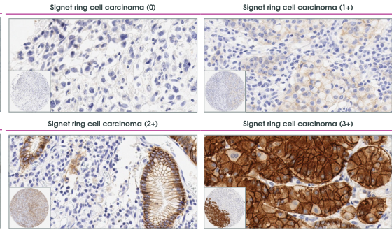 进展期胃癌靶向治疗之新星-Claudin 18.2 - 知乎