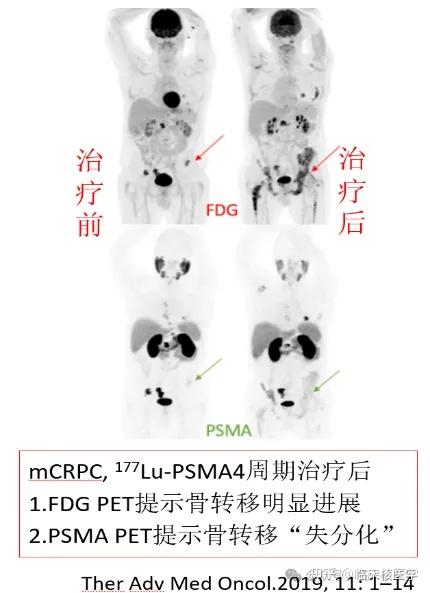 为什么有些前列腺癌患者需要PSMA & FDG PET/CT双显像？点击收藏！ - 知乎