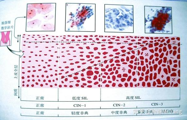 "CIN3"到底能不能按照原位癌去赔？ - 知乎