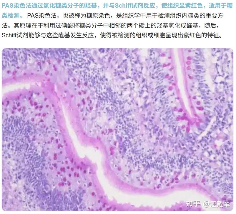 PAS染色+/PASD染色-，能证实细胞内存在糖原，但不足以诊断透明细胞型脑膜瘤 - 知乎